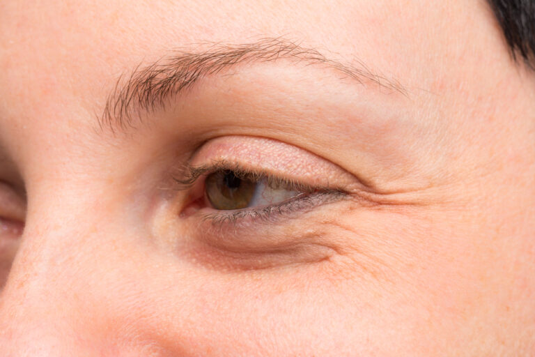 Can Eye Wrinkles Go Away: What You Need To Know
